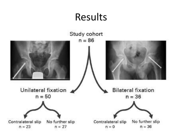 Contralateral fixation of scfe | PPT