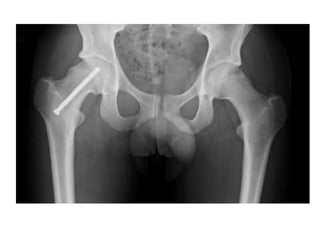 Contralateral fixation of scfe | PPT