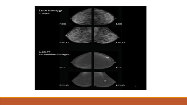 Contrast-enhanced Spectral Mammography.pptx