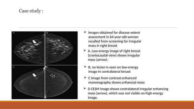 Contrast-enhanced Spectral Mammography.pptx