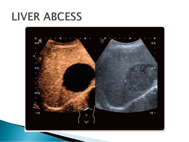 Contrast enhanced ultrasound