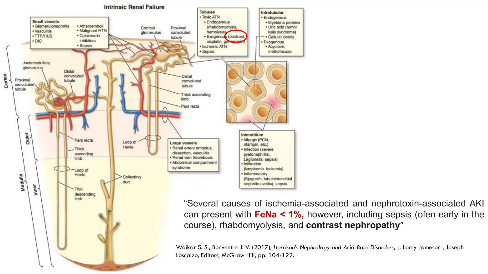Contrast induced nephropathy | PDF