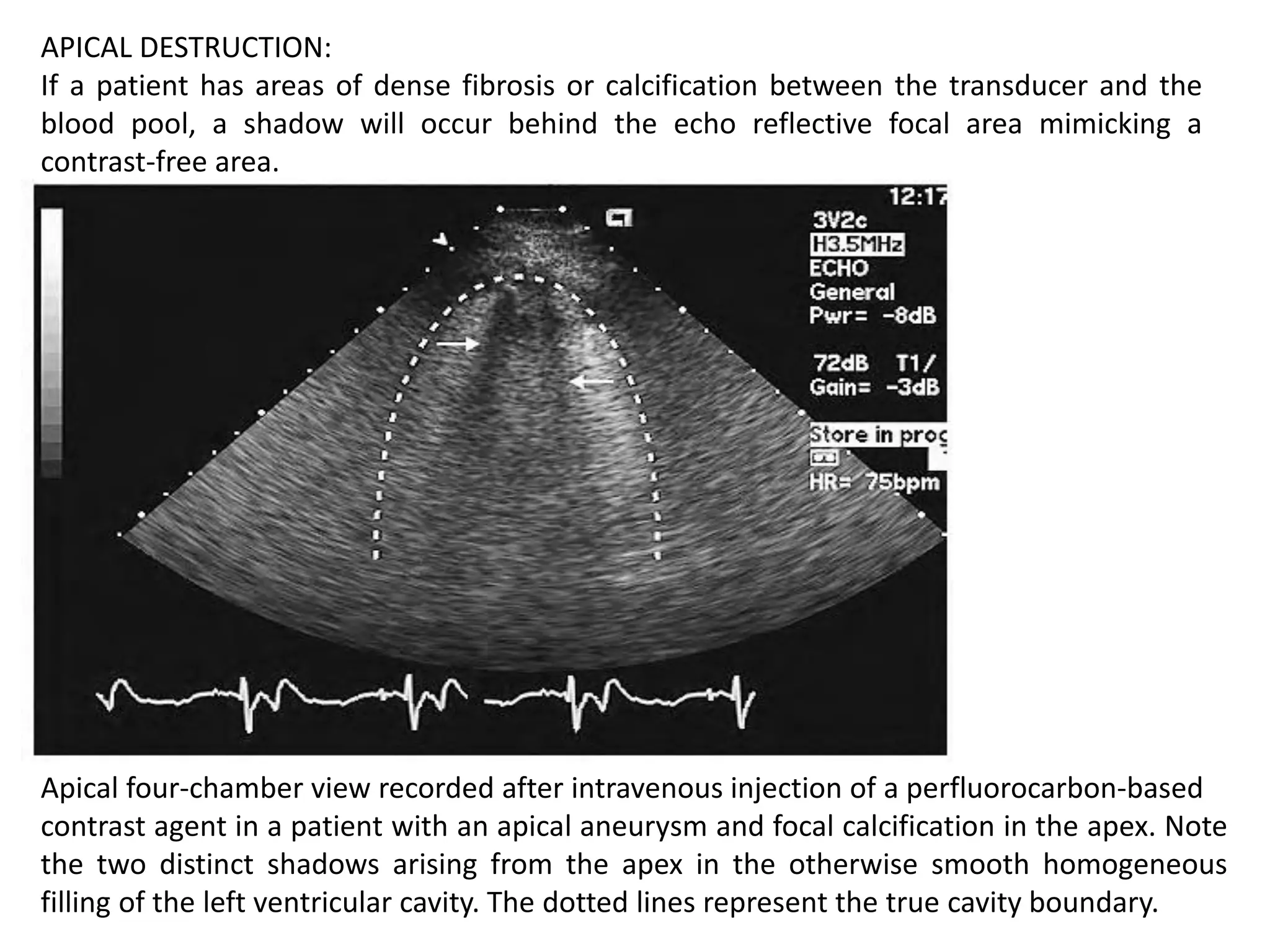 CONTRAST ECHOCARDIOGRAPHY | PDF