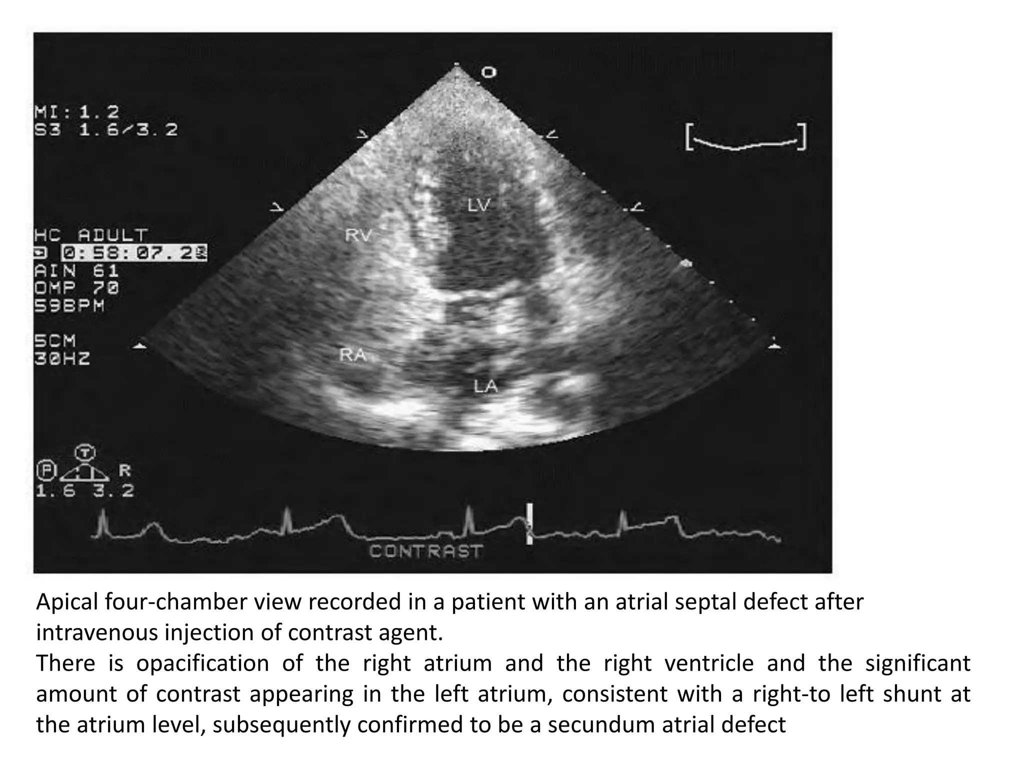 CONTRAST ECHOCARDIOGRAPHY | PDF