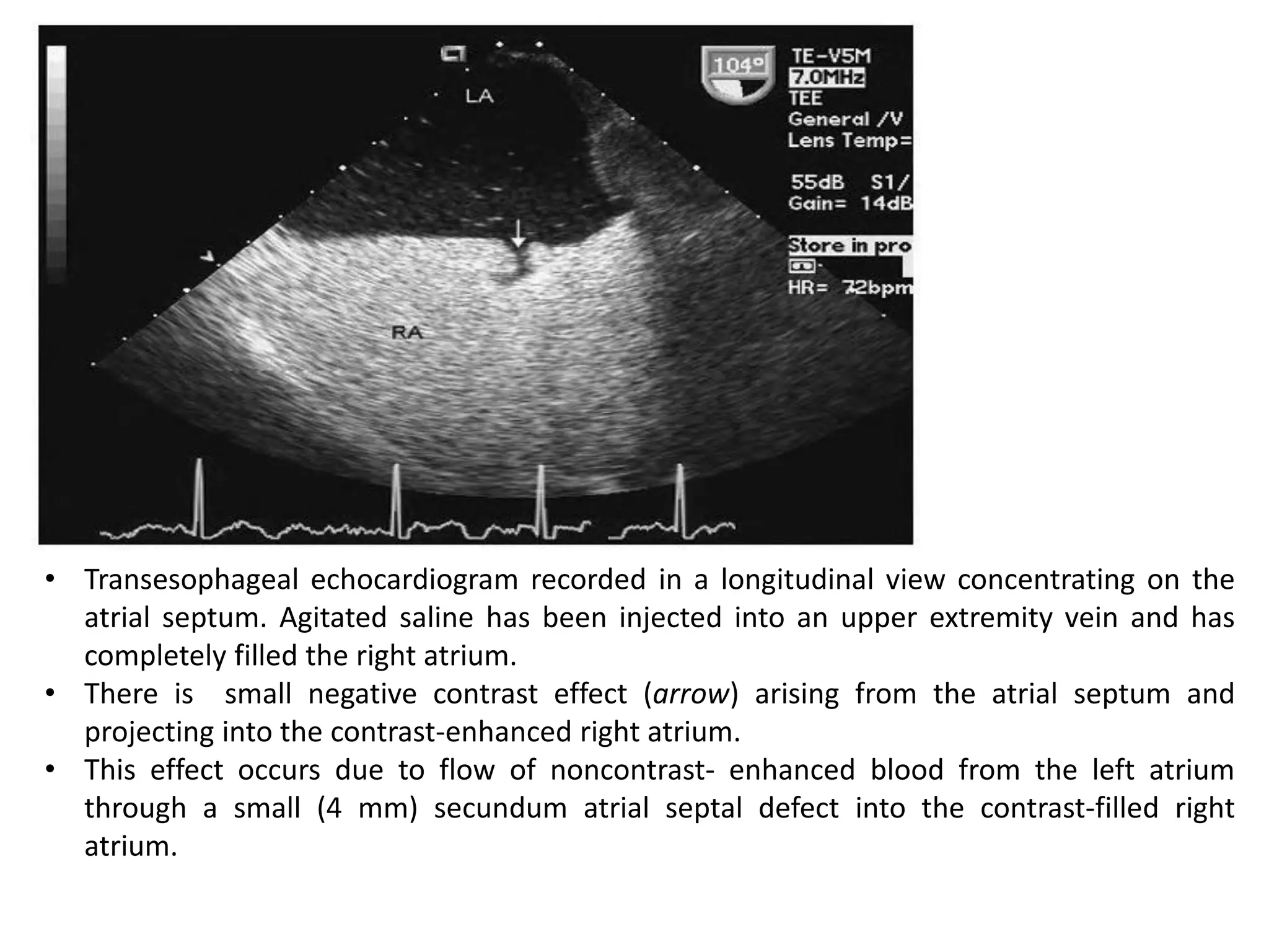 CONTRAST ECHOCARDIOGRAPHY | PDF