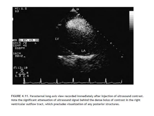CONTRAST ECHOCARDIOGRAPHY | PDF
