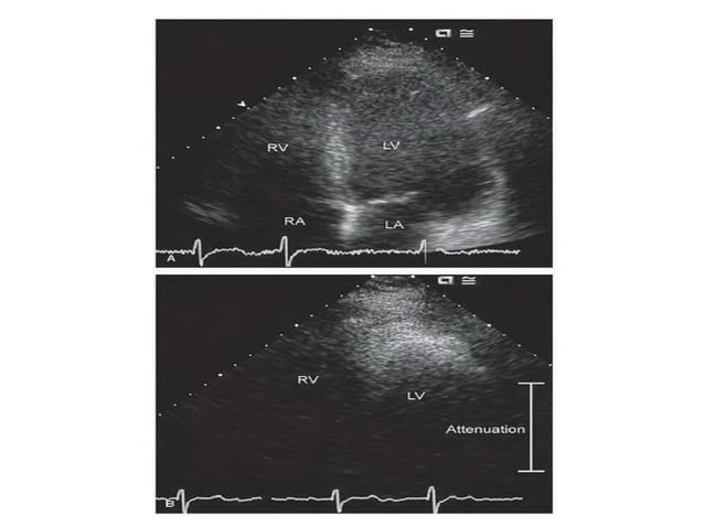CONTRAST ECHOCARDIOGRAPHY | PDF