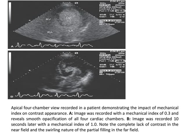 CONTRAST ECHOCARDIOGRAPHY | PDF