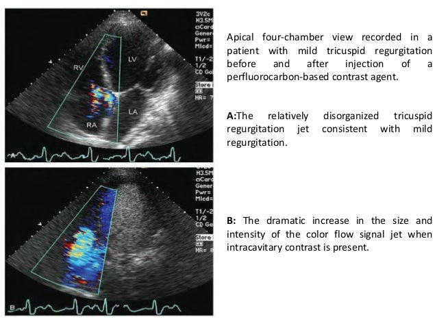 CONTRAST ECHOCARDIOGRAPHY