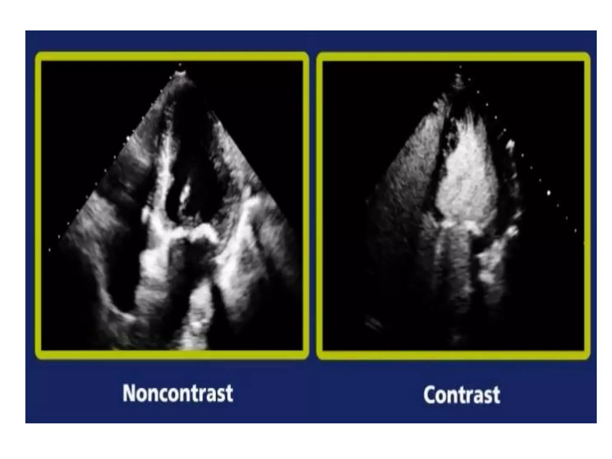Contrast echocardiography | PDF
