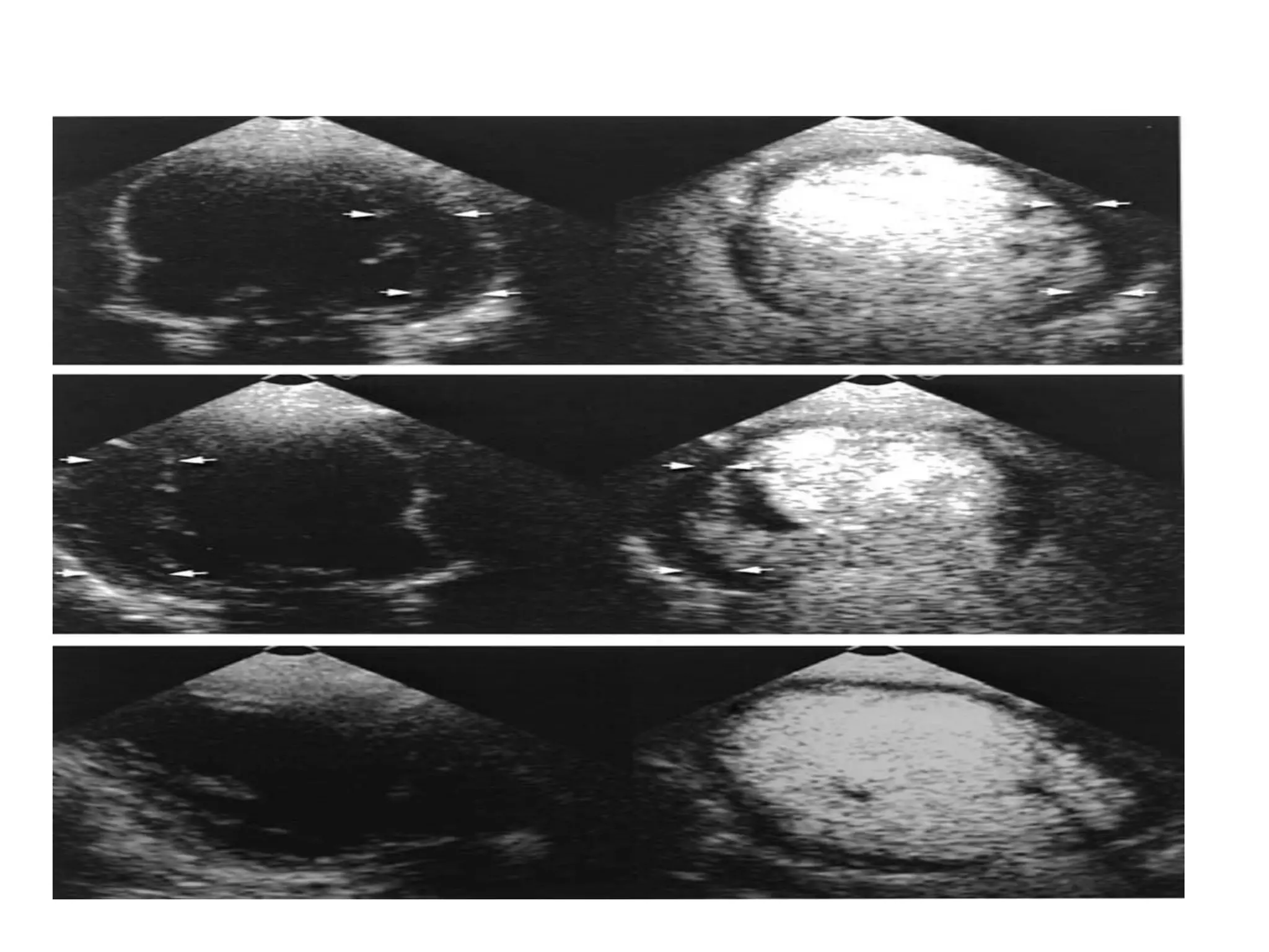 Contrast echocardiography | PDF