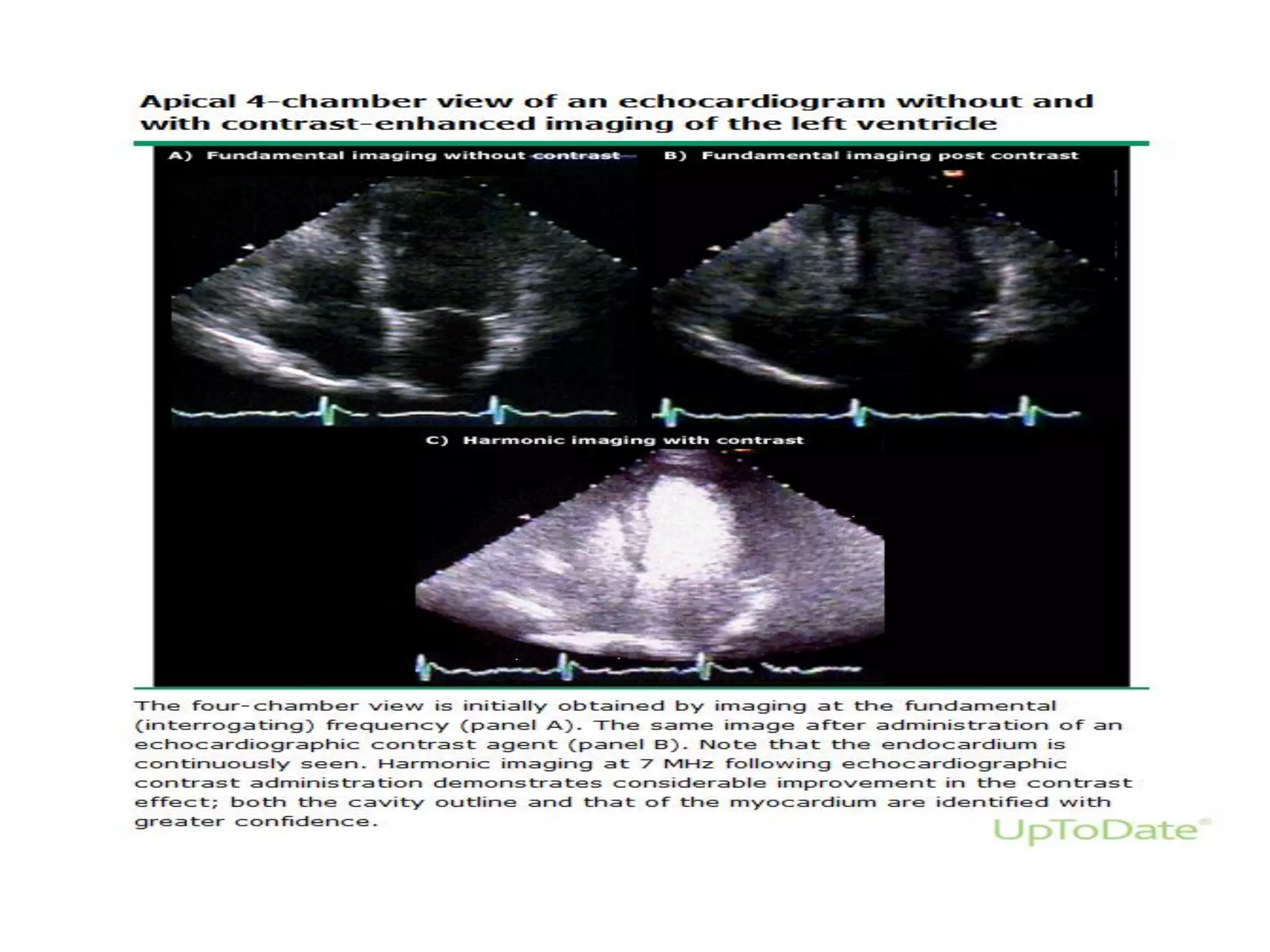 Contrast echocardiography | PDF