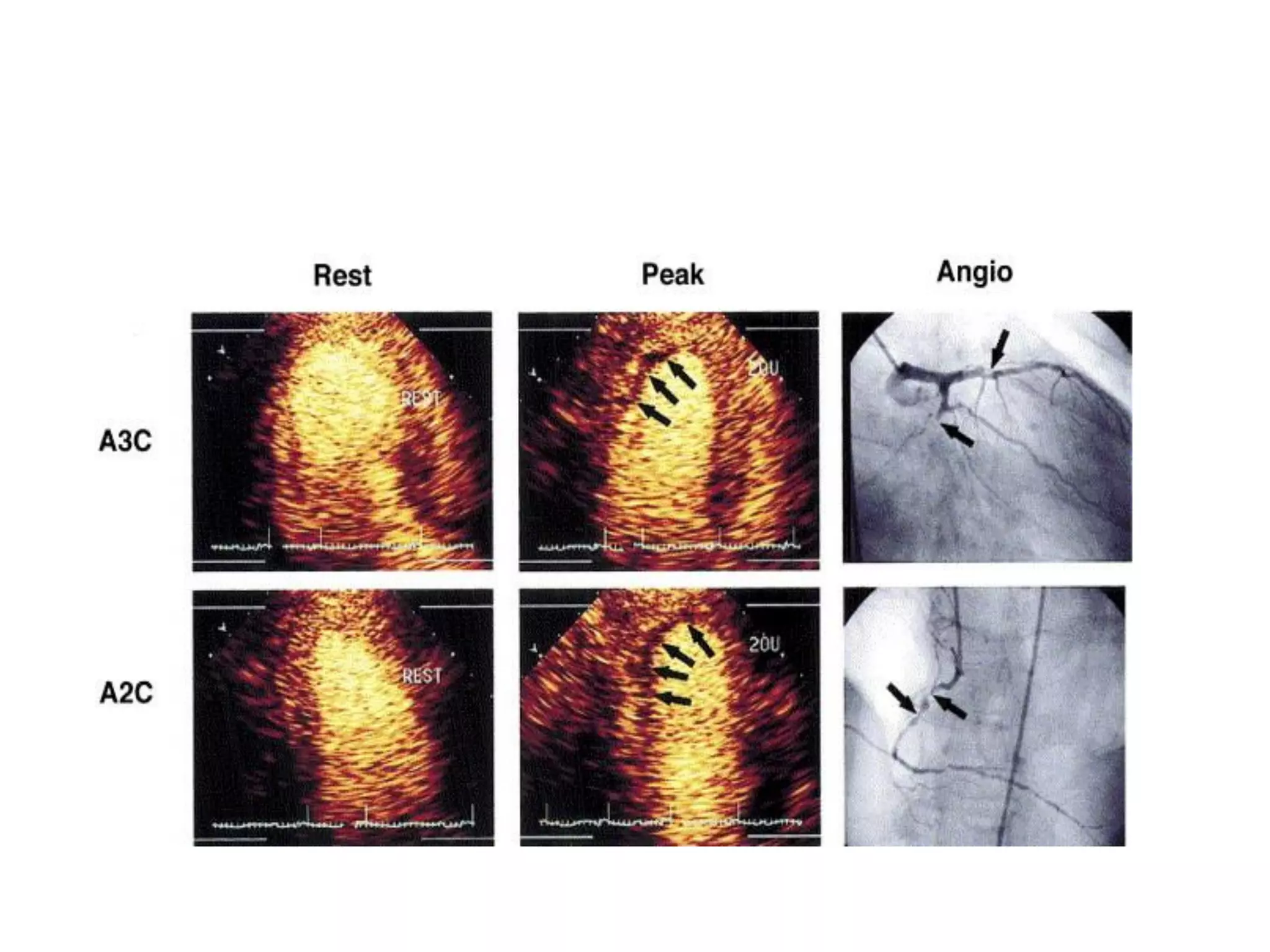 Contrast echocardiography | PDF