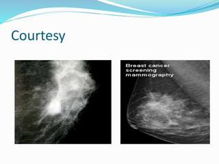 Contrast enhancement and fpga implementation of mammogram images for ...