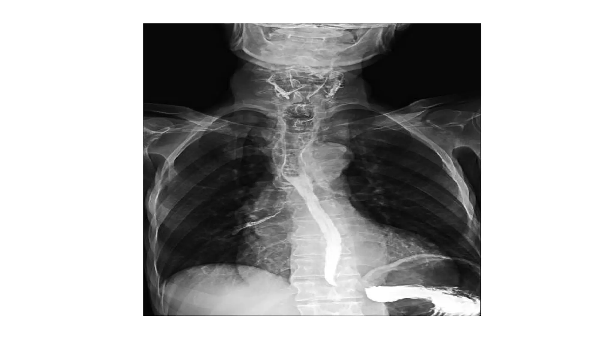 contrast examination barium study presentation.pptx