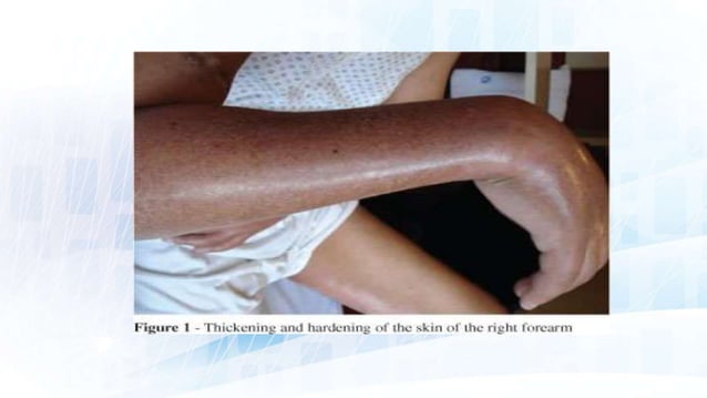 Contrast reactions and its management | PPTX | Allergies | Diseases and ...