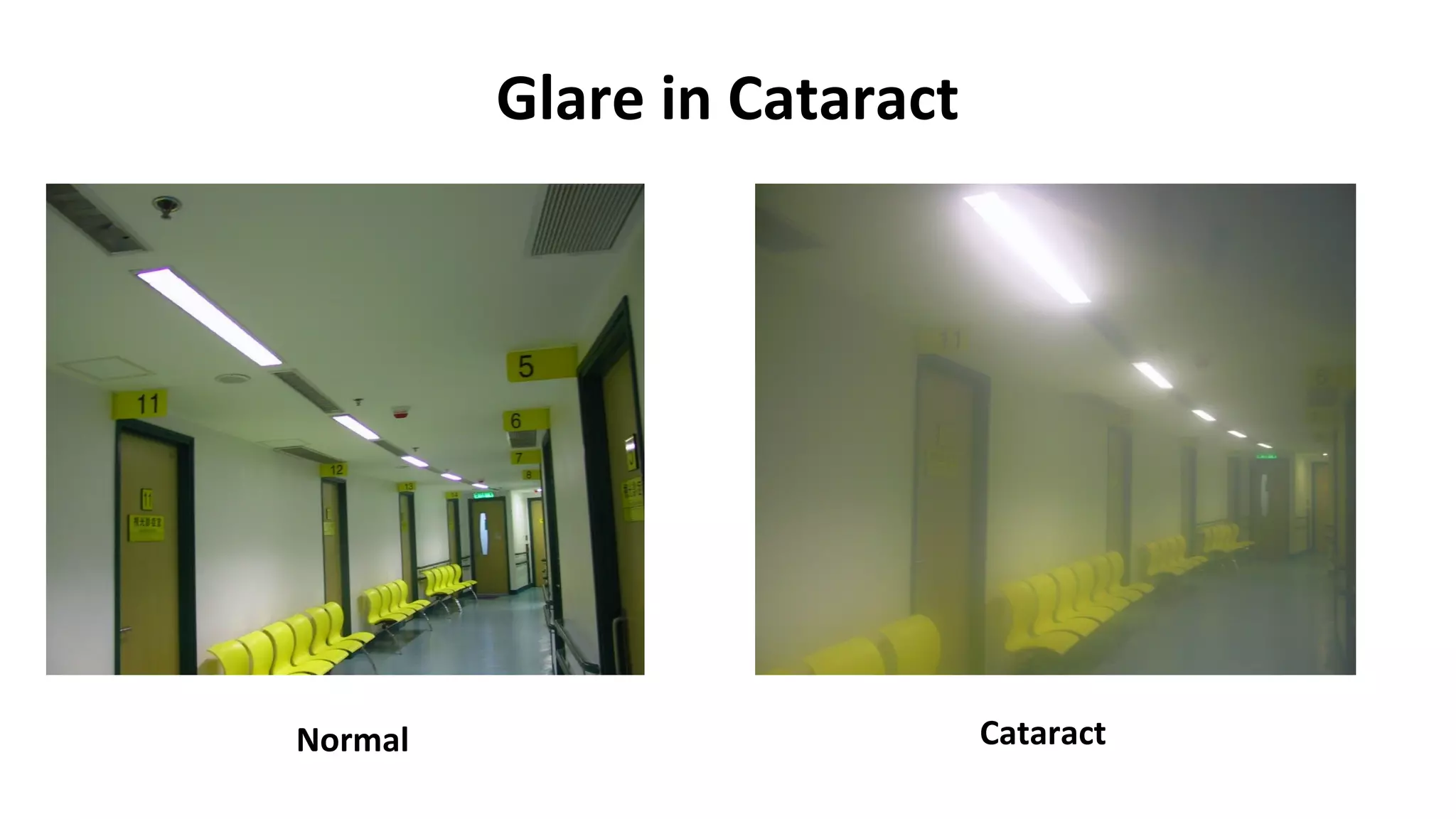 Contrast sensitivity, Clinical assessment of intra-ocular light scatter ...