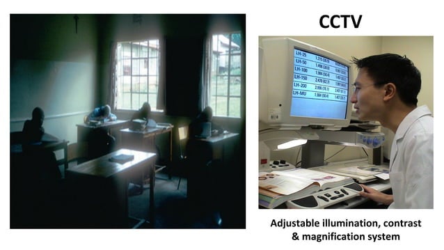 Contrast sensitivity, Clinical assessment of intra-ocular light scatter ...
