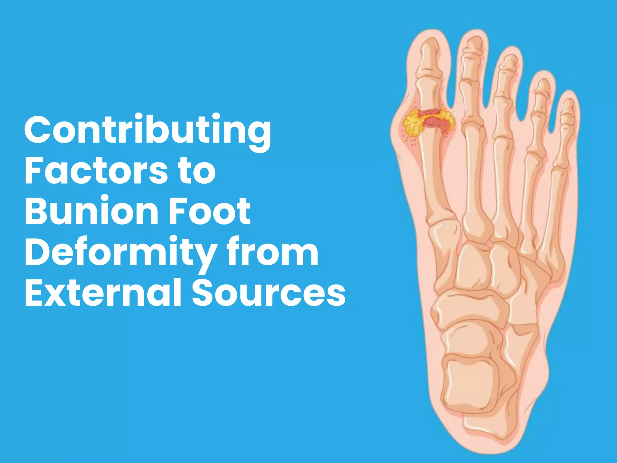 Contributing Factors to Bunion Foot Deformity from External Sources.pptx
