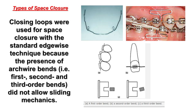 orthodontic controlled space closure | PPTX | Dental Health | Diseases ...