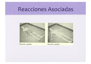 Control reflejo postural anormal | PDF