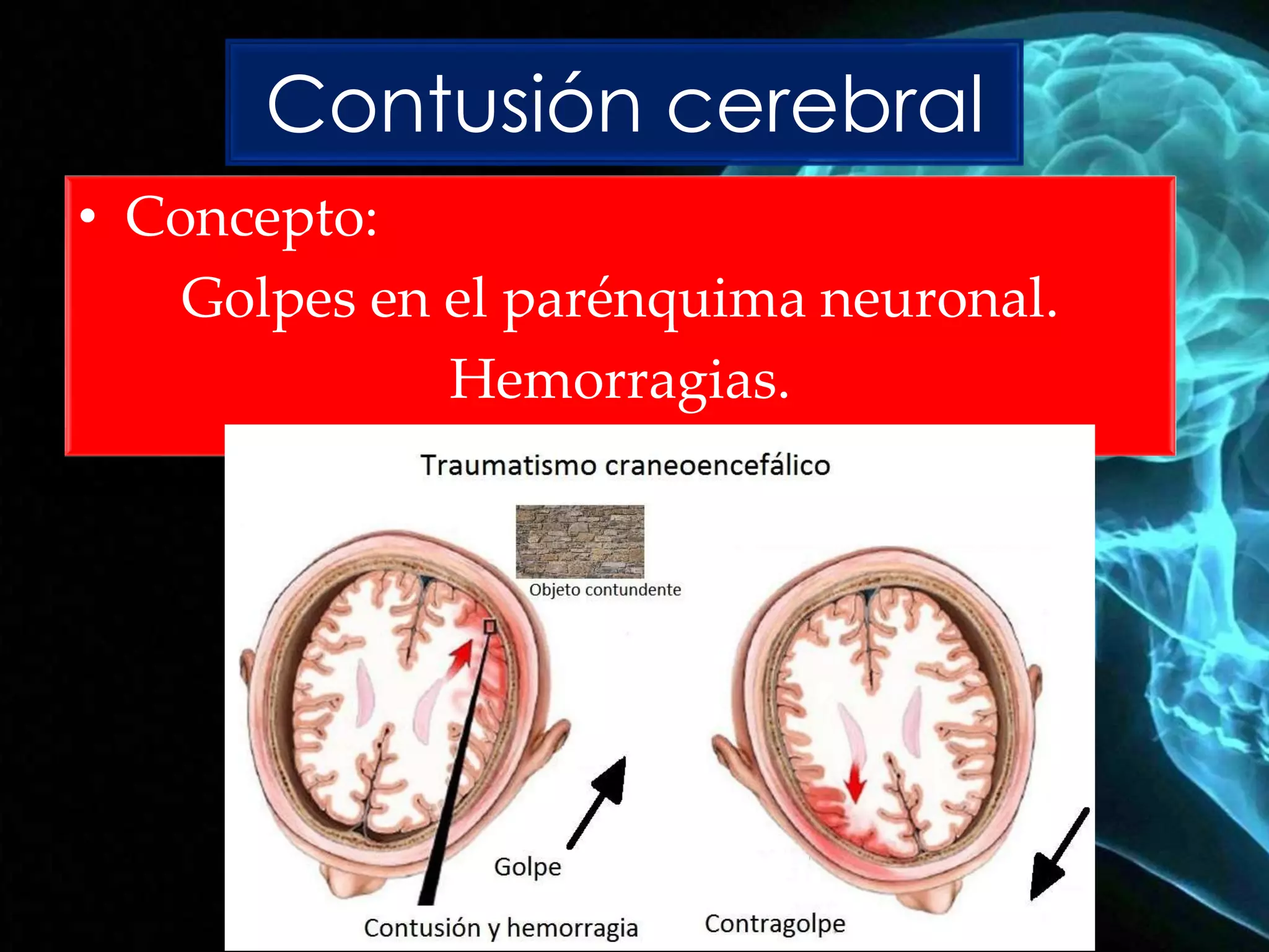 Contusión cerebral trauma cráneo-encefálico | PPTX