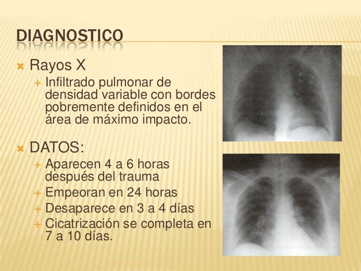 Contusion Pulmonar