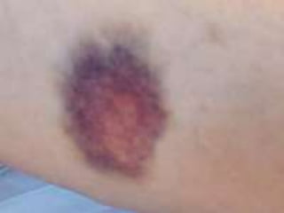 Contusion - A physical injury. It happen by any road accident, falling ...
