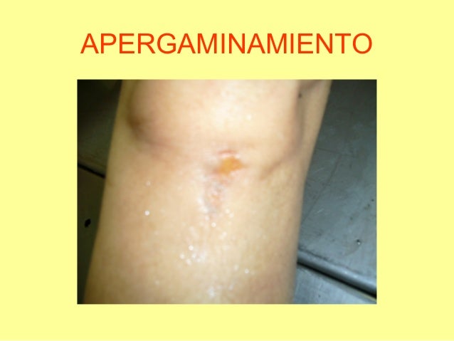 Contusiones cruz roja