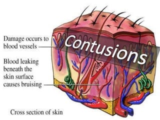 Contusions & abrasions | PPT