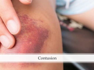 Contusions_Haematomas_Presentssssation.pdf