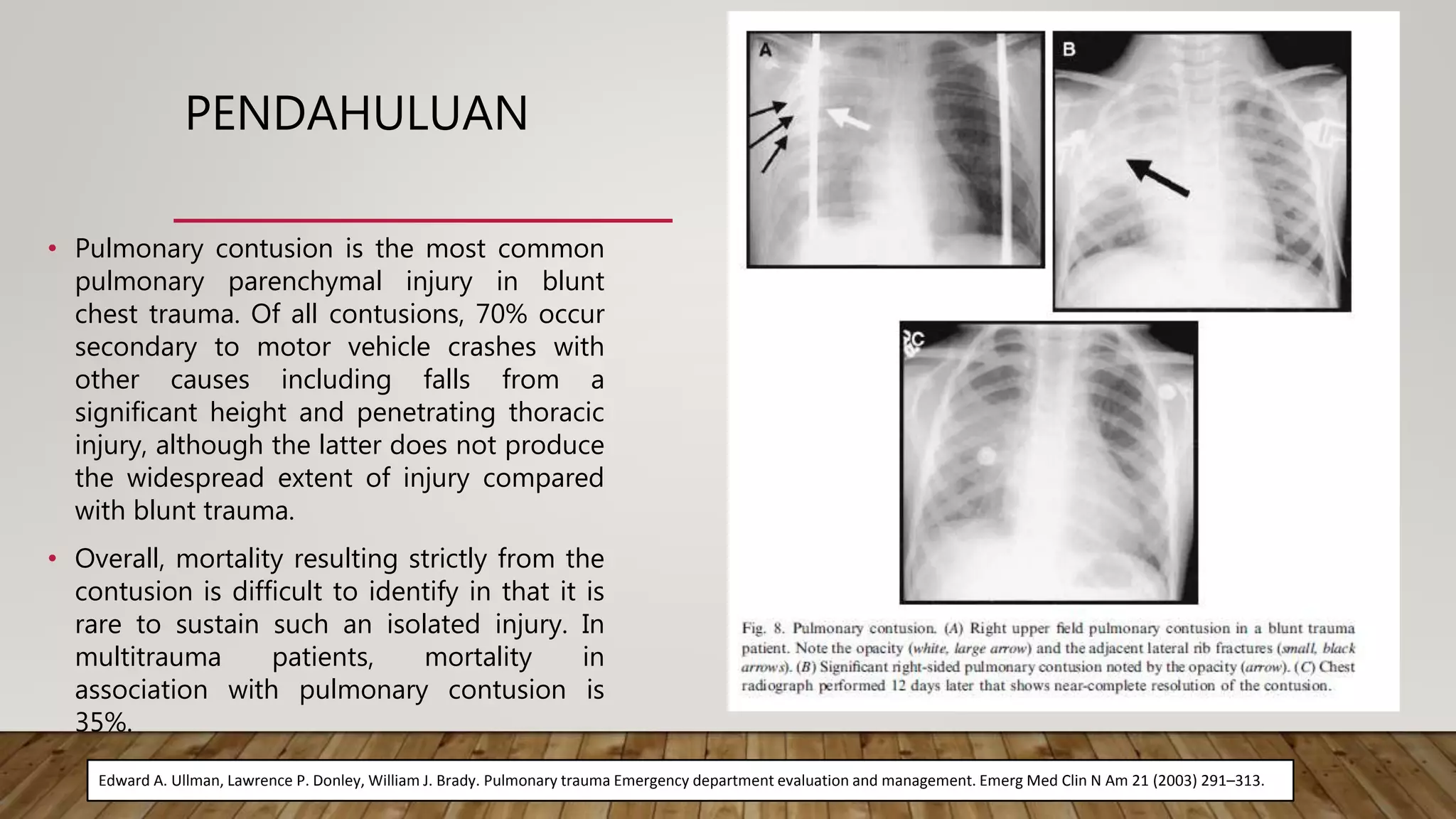 pulmonary contusion | PPTX