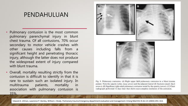 pulmonary contusion | PPTX