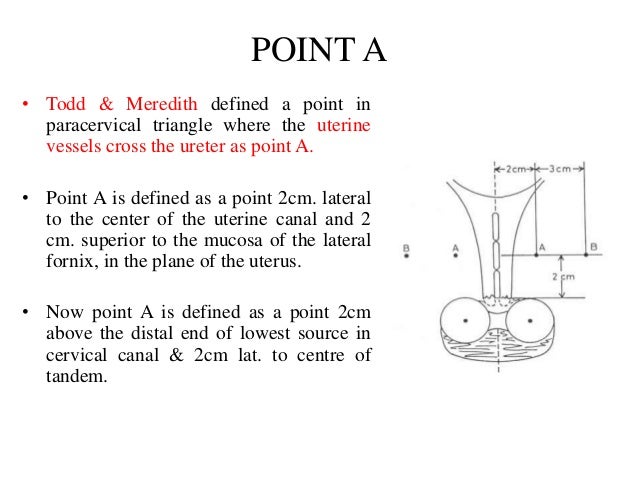 Conventional Brachytherapy in carcinoma cervix