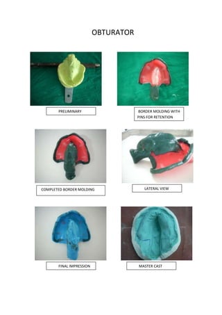 Conventional complete denture /certified fixed orthodontic courses by ...