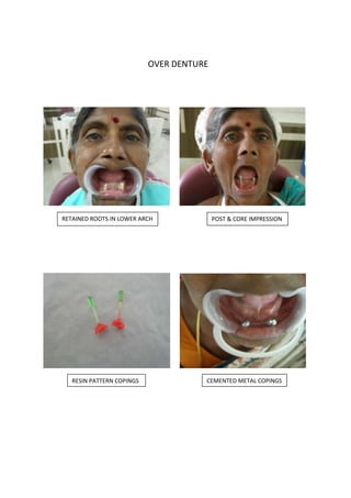 Conventional complete denture /certified fixed orthodontic courses by ...