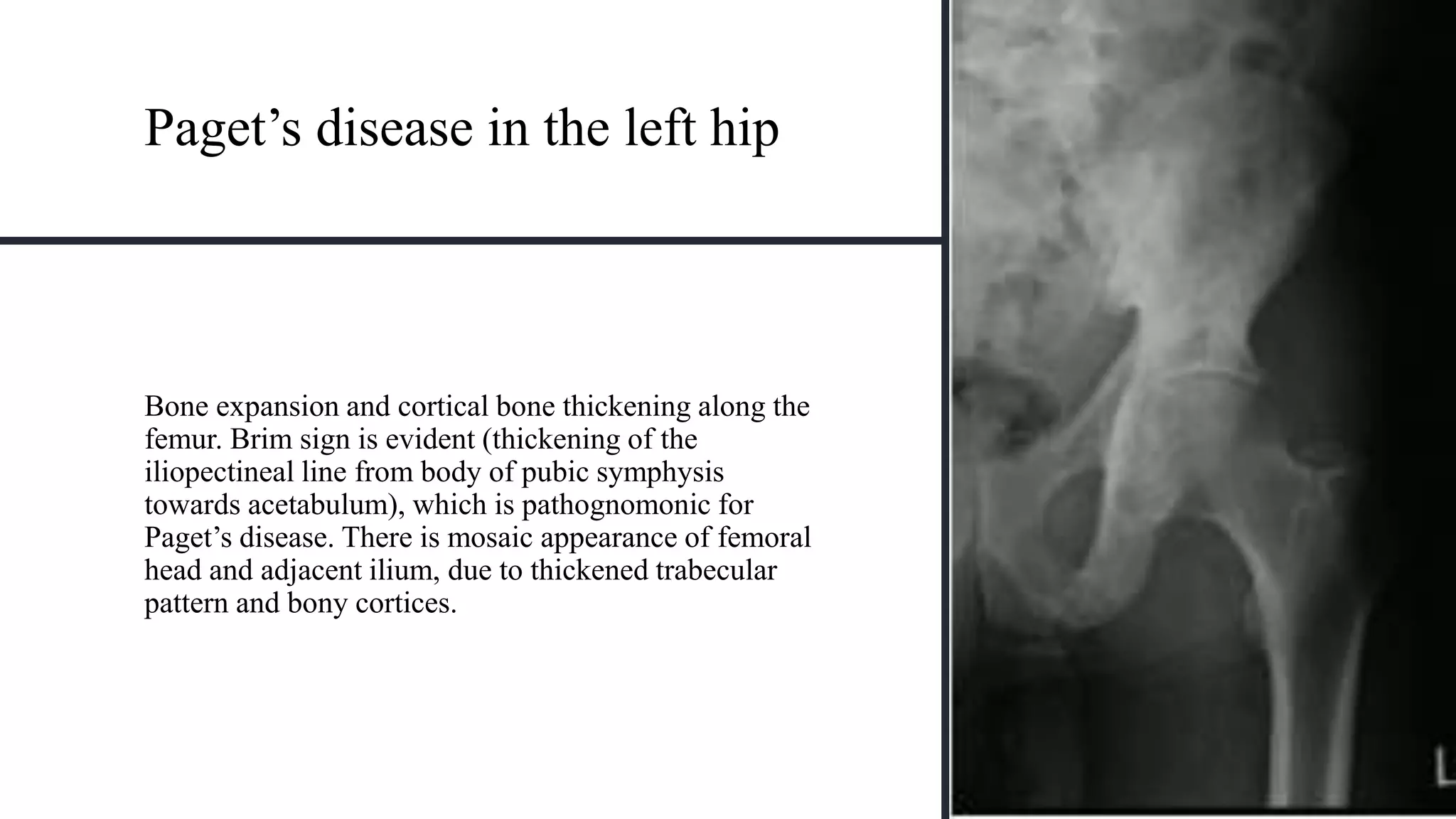 Conventional radiography in Rheumatic diseases | PPTX