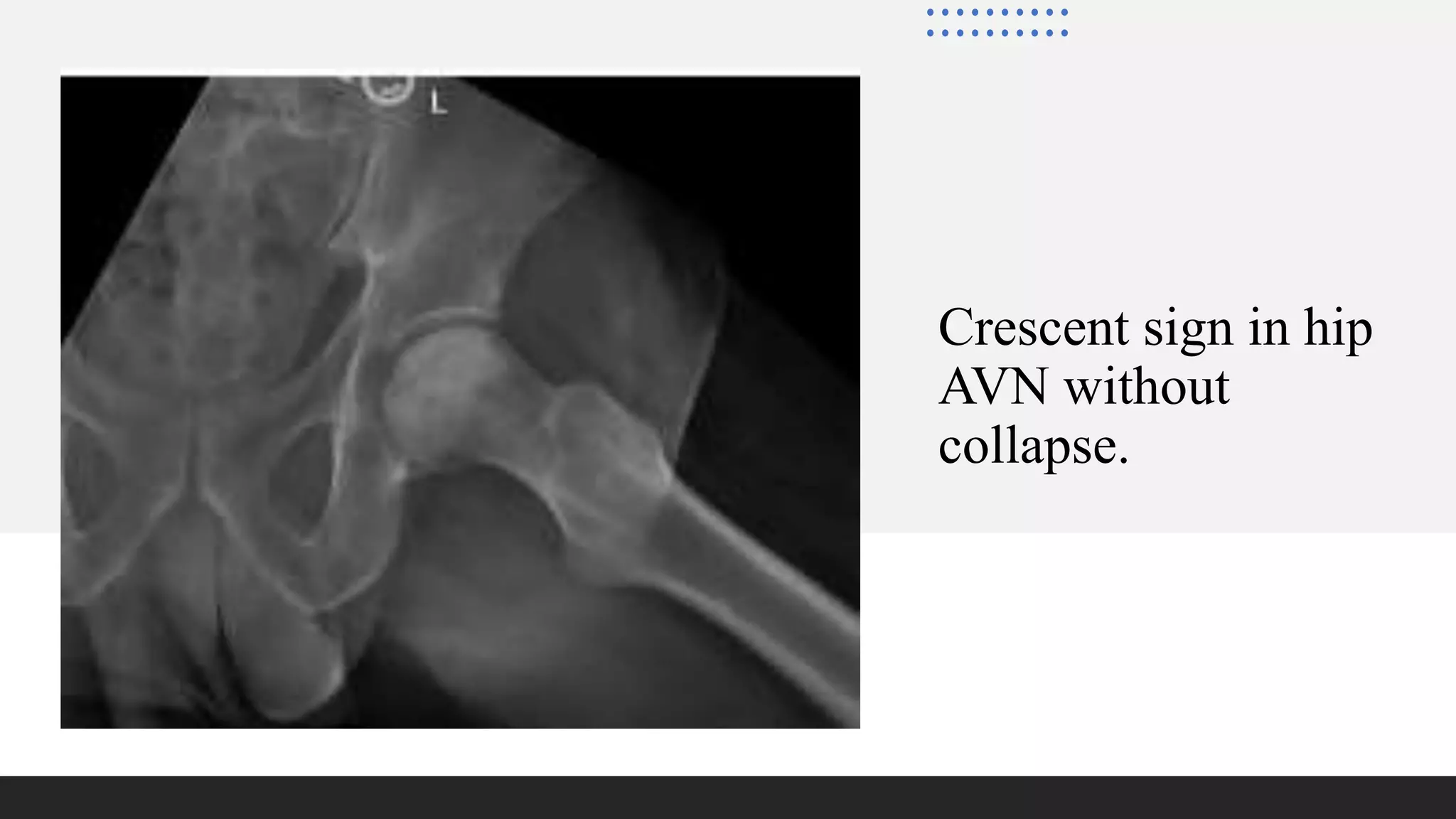 Conventional radiography in Rheumatic diseases | PPTX