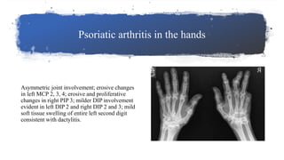 Conventional radiography in Rheumatic diseases | PPTX