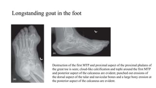 Conventional radiography in Rheumatic diseases | PPTX