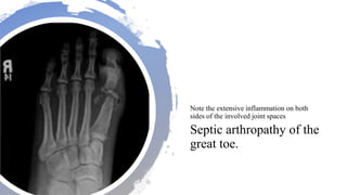 Conventional radiography in Rheumatic diseases | PPTX