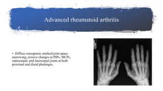 Conventional radiography in Rheumatic diseases | PPTX