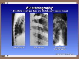 CONVENTIONAL TOMOGRAPHY.ppt