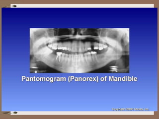 CONVENTIONAL TOMOGRAPHY.ppt