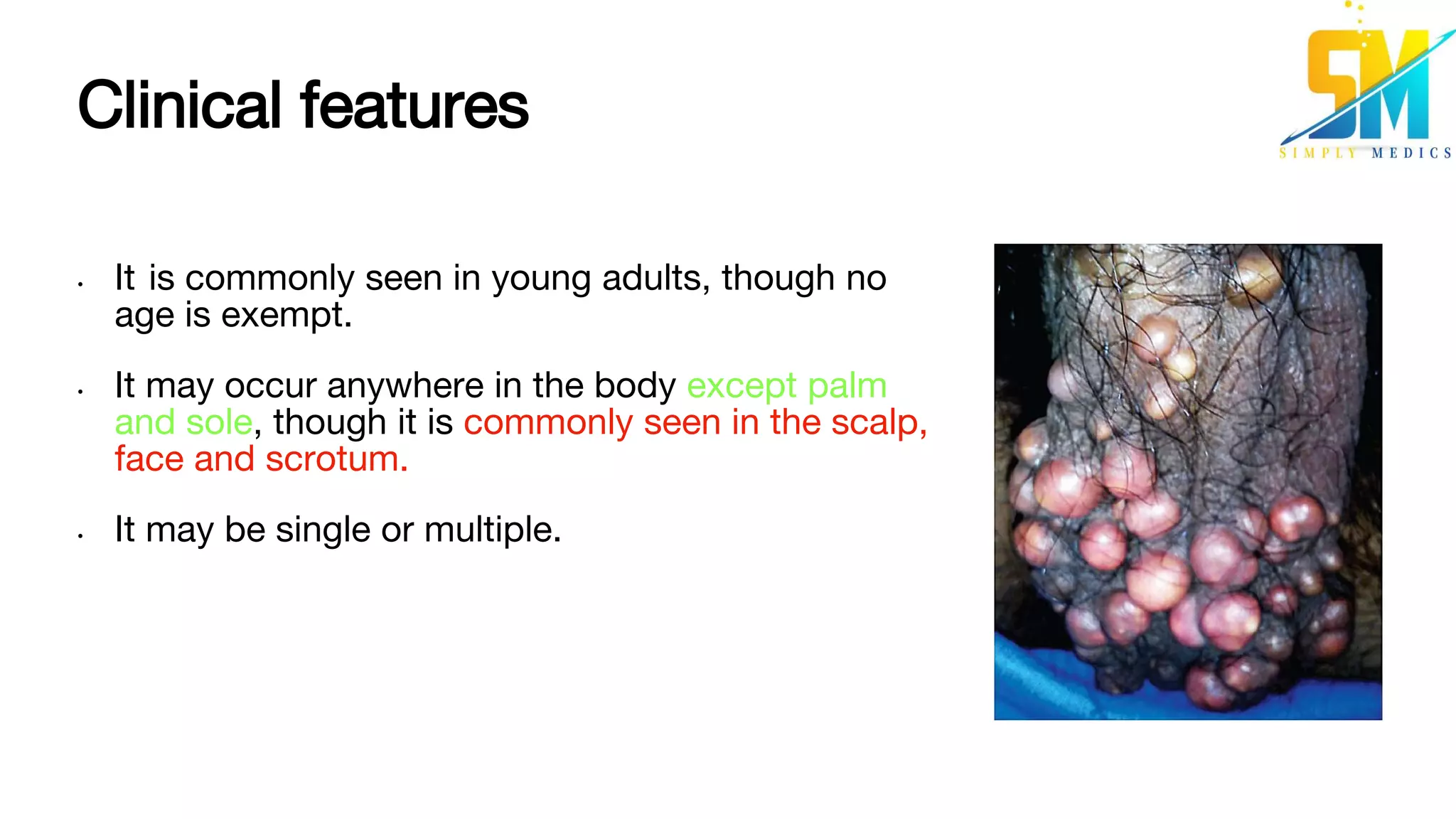 sebaceous cyst | PPTX