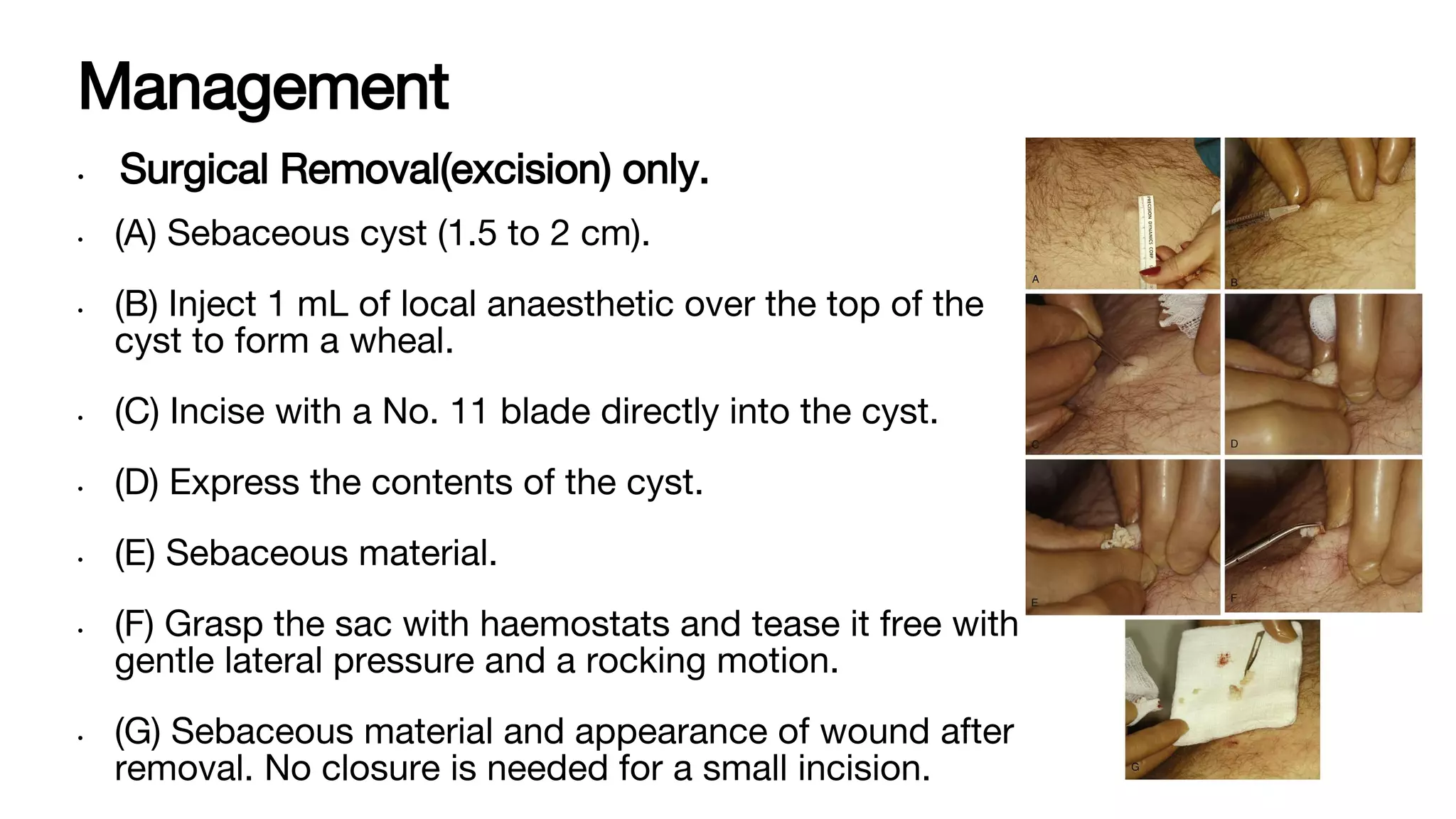 sebaceous cyst | PPTX