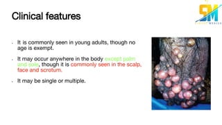 sebaceous cyst | PPTX