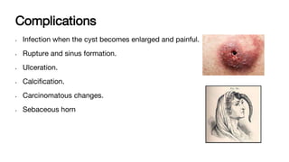 sebaceous cyst | PPTX