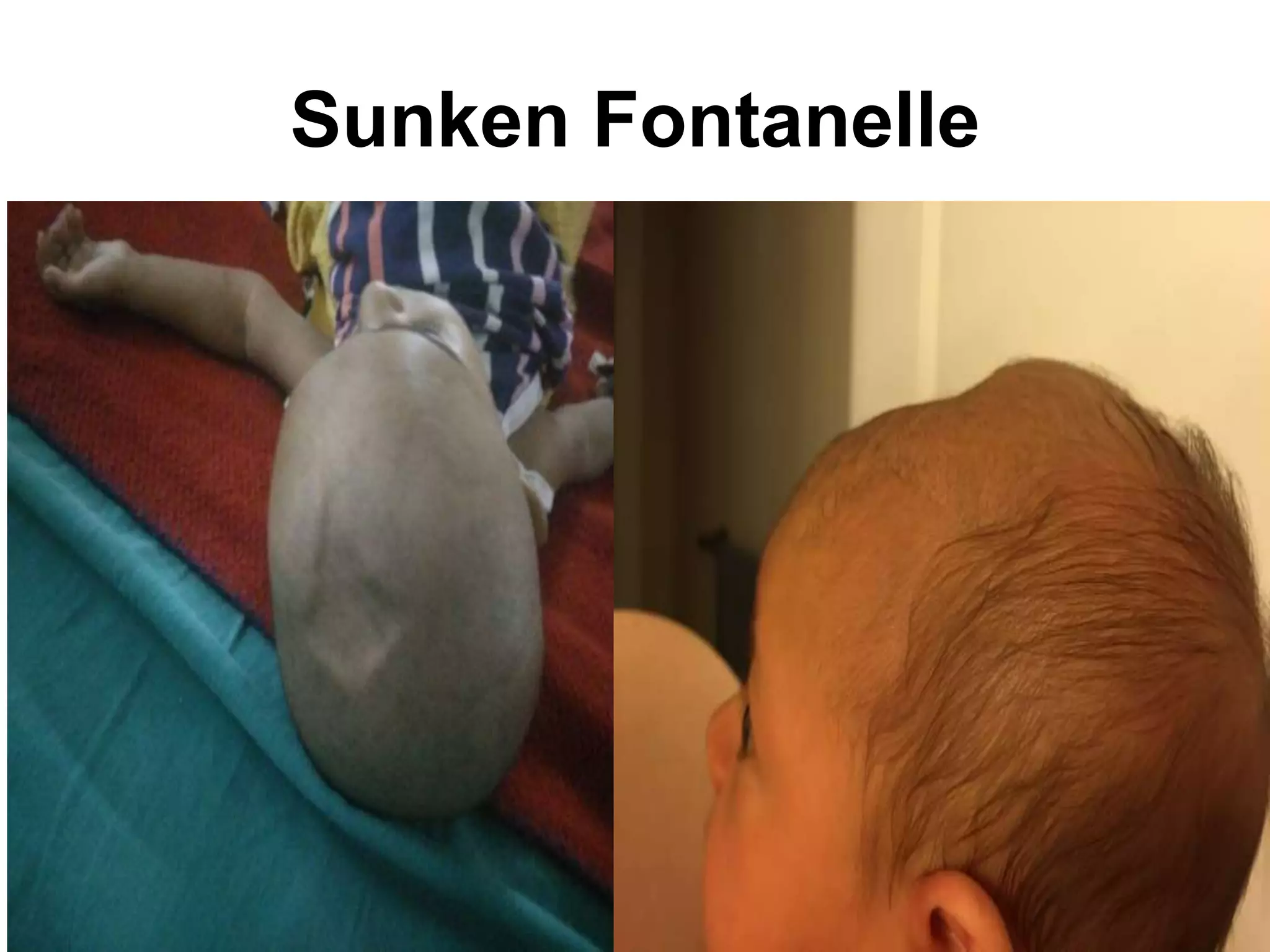 Convulsion and neonatal hyperthermia | PPTX