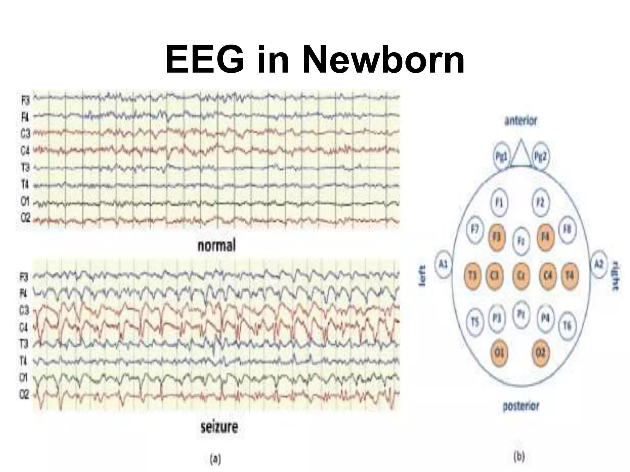 Convulsion and neonatal hyperthermia | PPTX